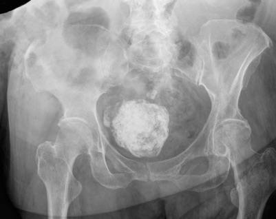 This Woman had a Fibroid the Size of a Baby! | Blog